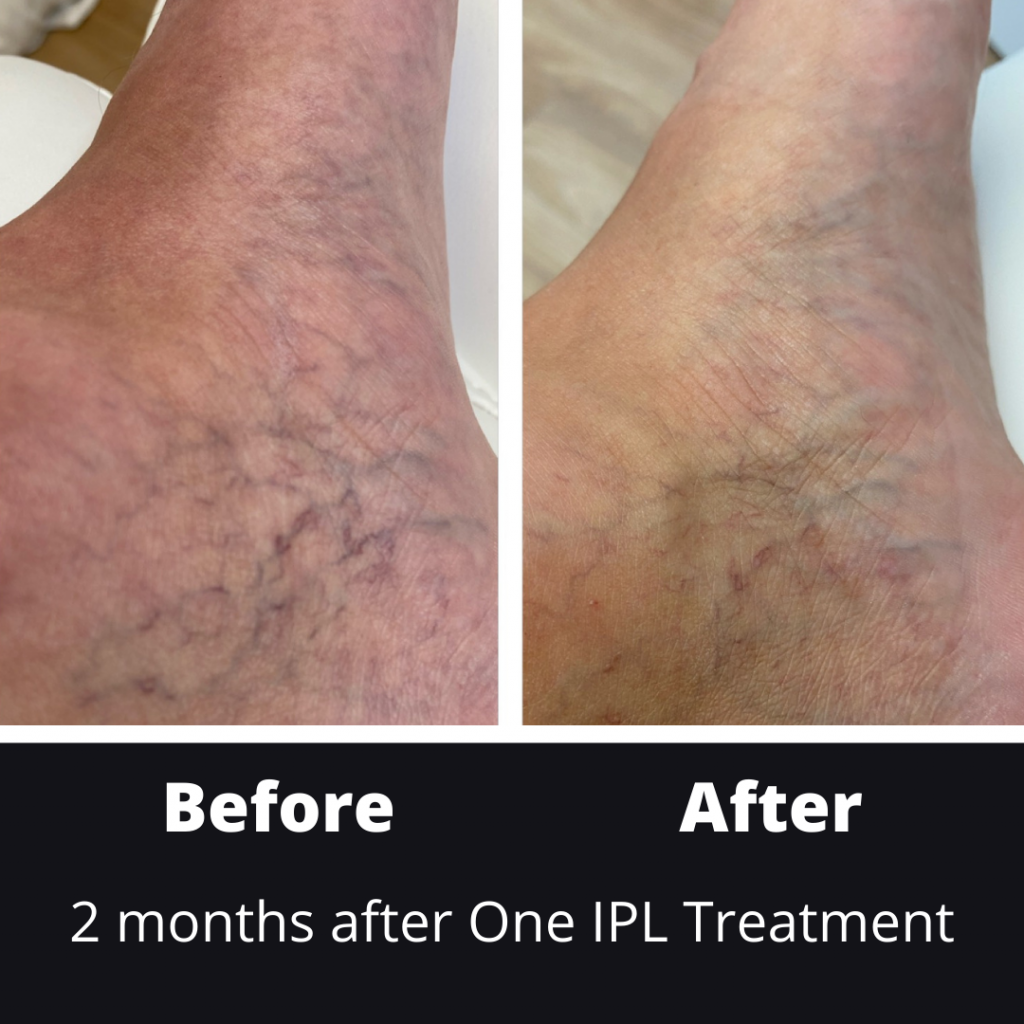 Spider Veins & Varicose Veins - East Toronto, Scarborough, Beaches ...