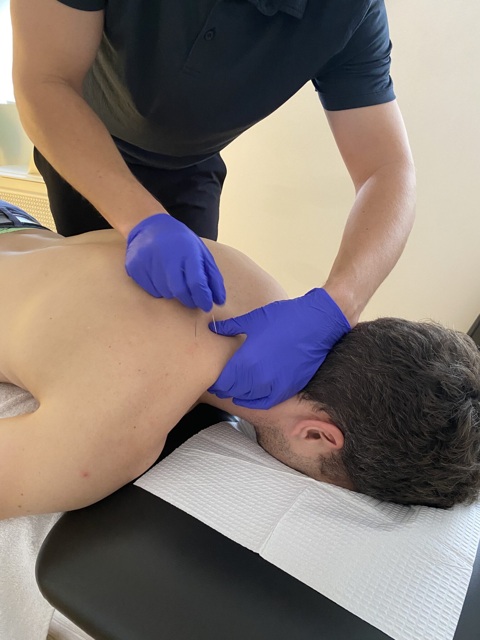 Dry Needling Explained - Beachealth